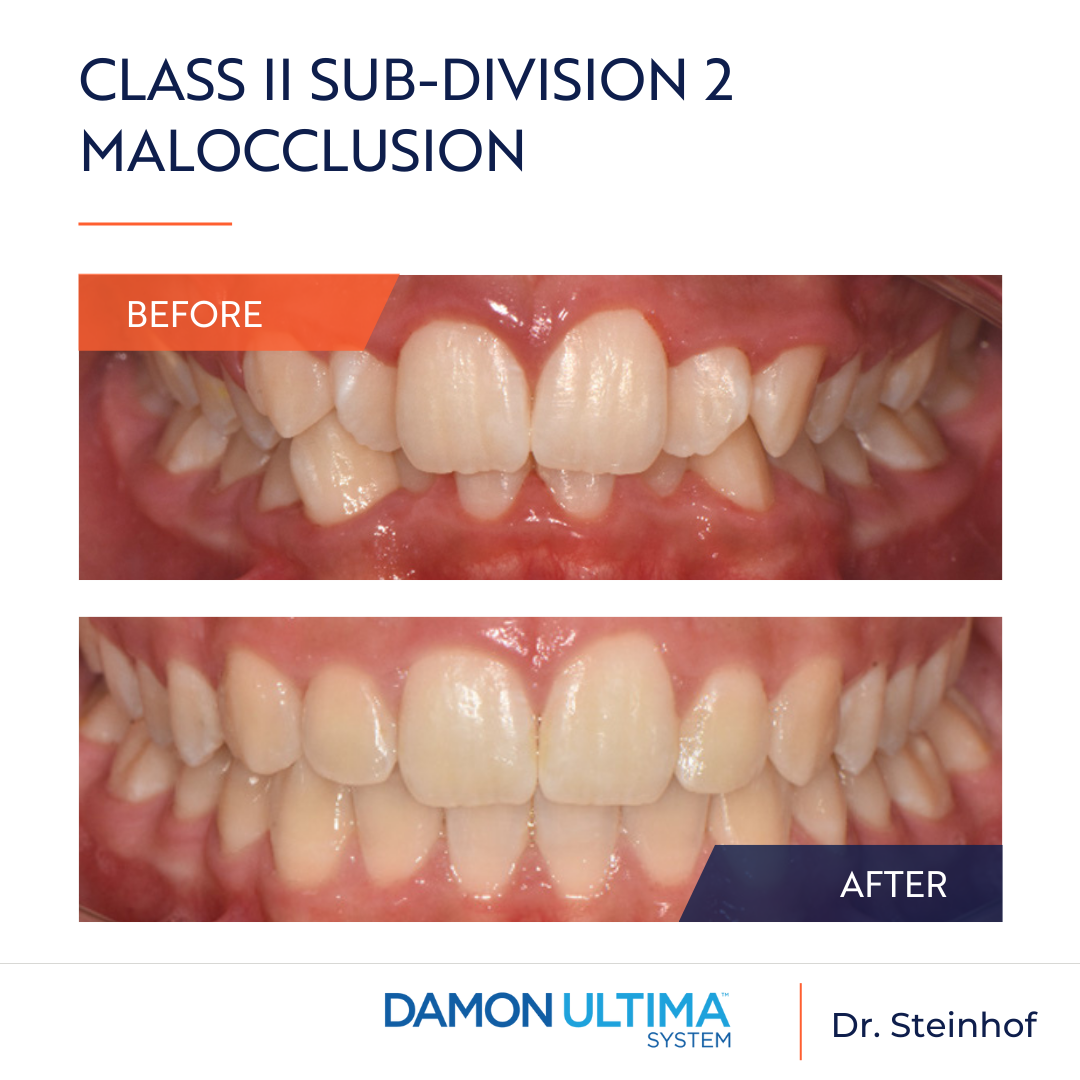 Malocclusion de classe II, sous-division 2, avec un encombrement ...