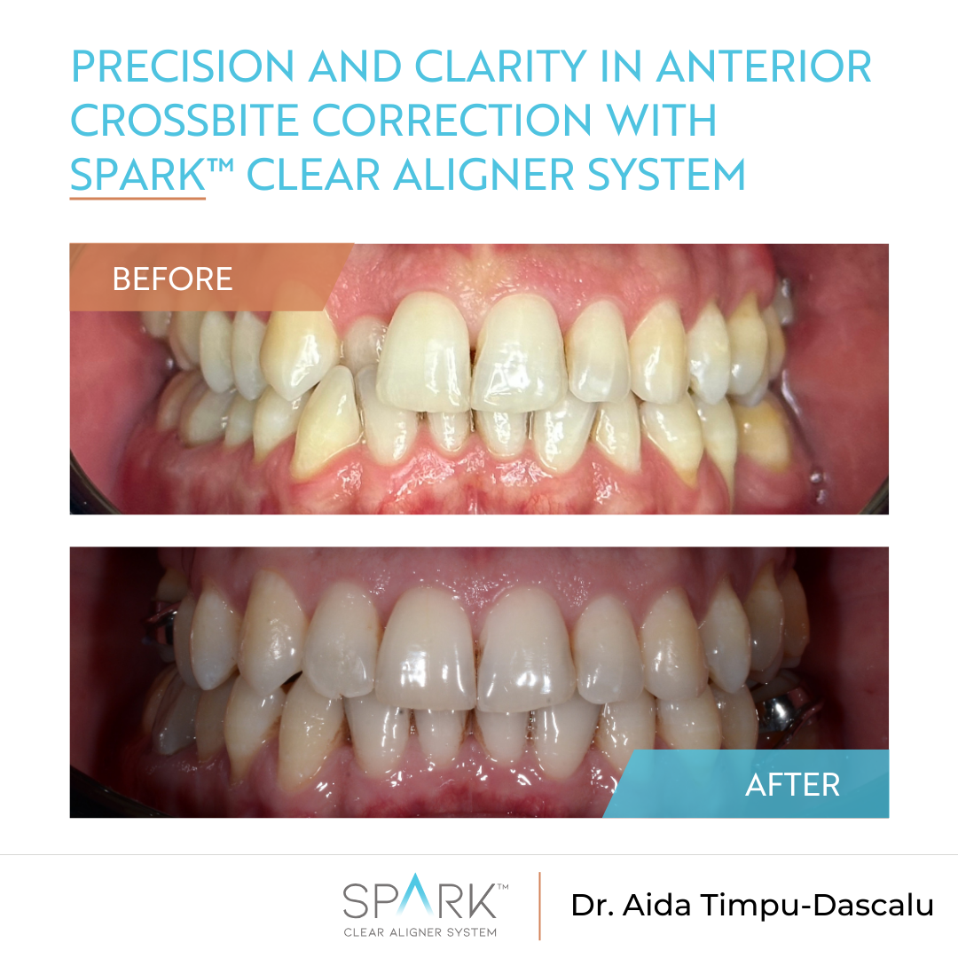 Precision and clarity in anterior crossbite correction with Spark™ Clear Aligner system - Ormco